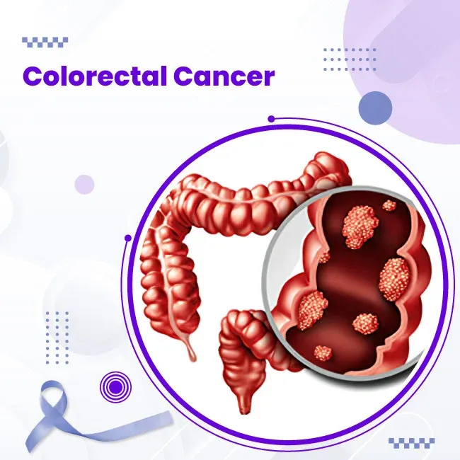 Colorectal cancer cases in kids